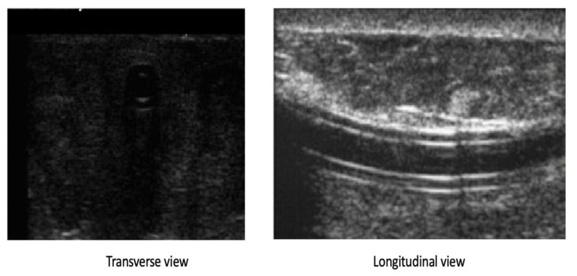 Bedside Ultrasonography of the Peritoneal Dialysis Catheter - Renal ...