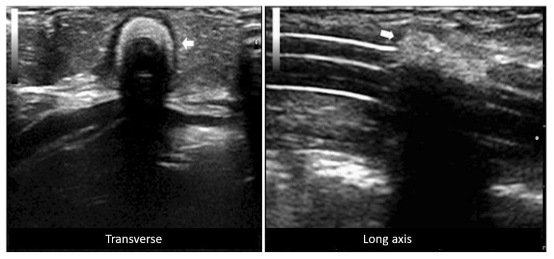 Bedside Ultrasonography of the Peritoneal Dialysis Catheter - Renal ...