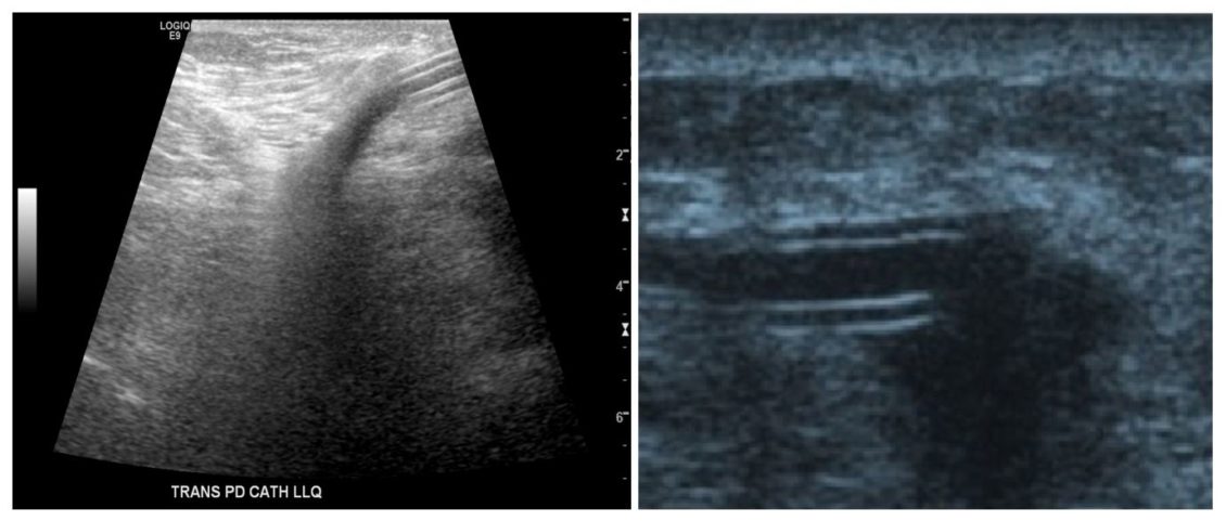 Bedside Ultrasonography of the Peritoneal Dialysis Catheter - Renal ...