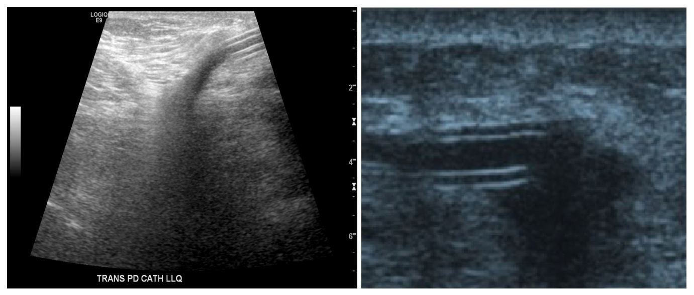 Bedside Ultrasonography of the Peritoneal Dialysis Catheter - Renal ...