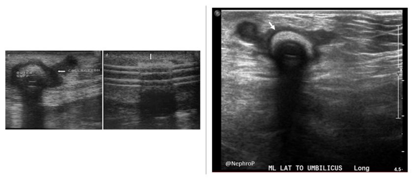 Bedside Ultrasonography of the Peritoneal Dialysis Catheter - Renal ...