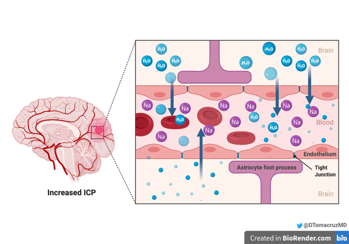 Dealing with hypertonic saline in the Neuro-ICU - Renal Fellow Network