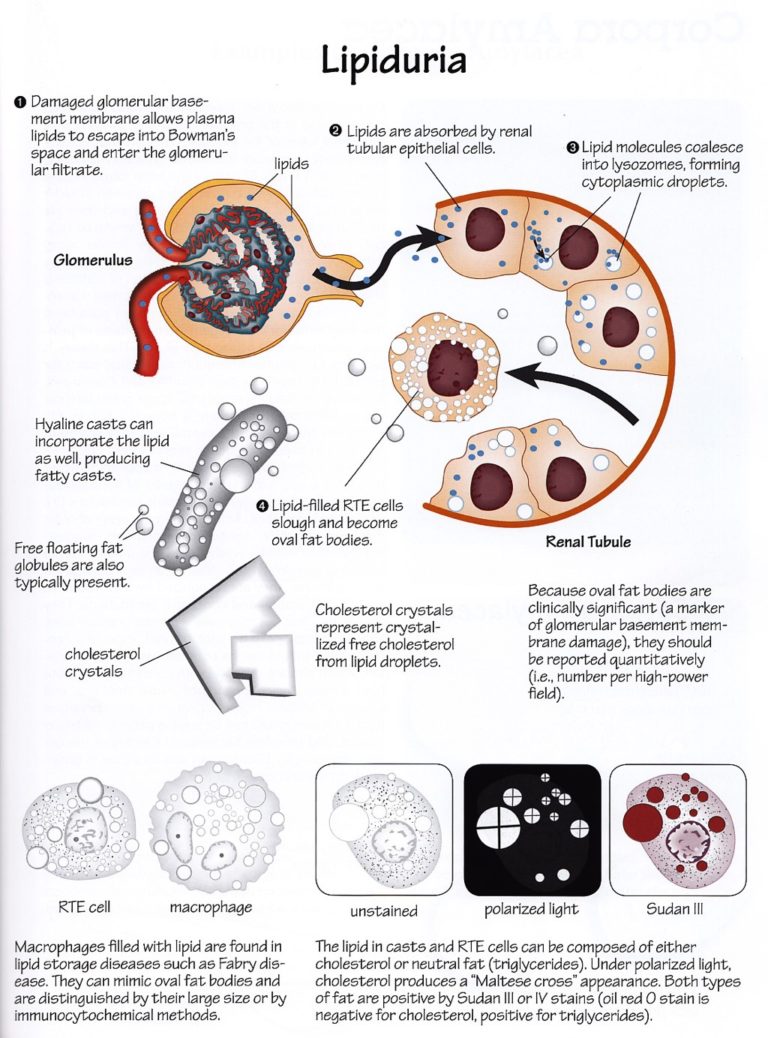 Urine Sediment of the Month: All About Those Oval Fat Bodies - Renal ...
