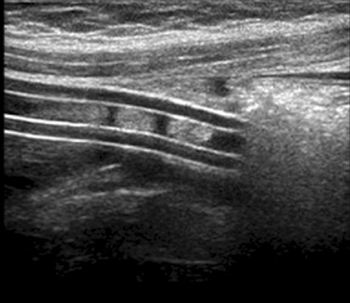 Bedside Ultrasonography of the Peritoneal Dialysis Catheter - Renal ...