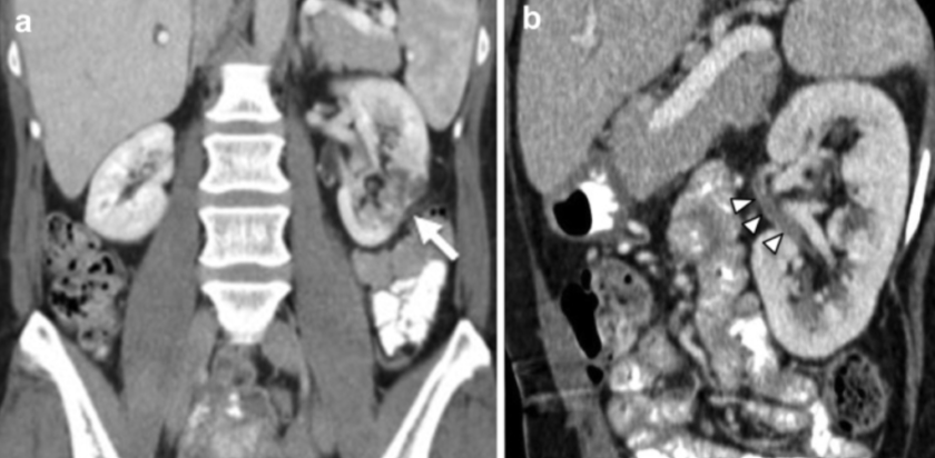 St Anthony’s Fire: Ergot and the Kidney - Renal Fellow Network