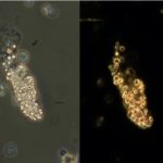 Urine Sediment of the Month: All About Those Oval Fat Bodies - Renal ...