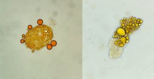 Urine Sediment of the Month: All About Those Oval Fat Bodies - Renal ...