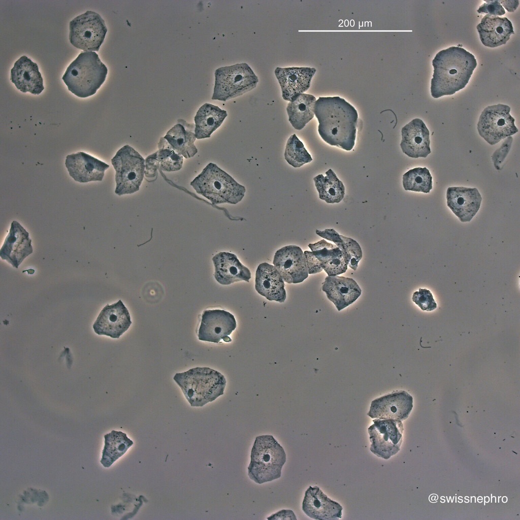 Urine Sediment Of The Month 4 Flavors Of Nucleated Cells Renal urine-sediment-of-the-month-4-flavors-of-nucleated-cells-renal