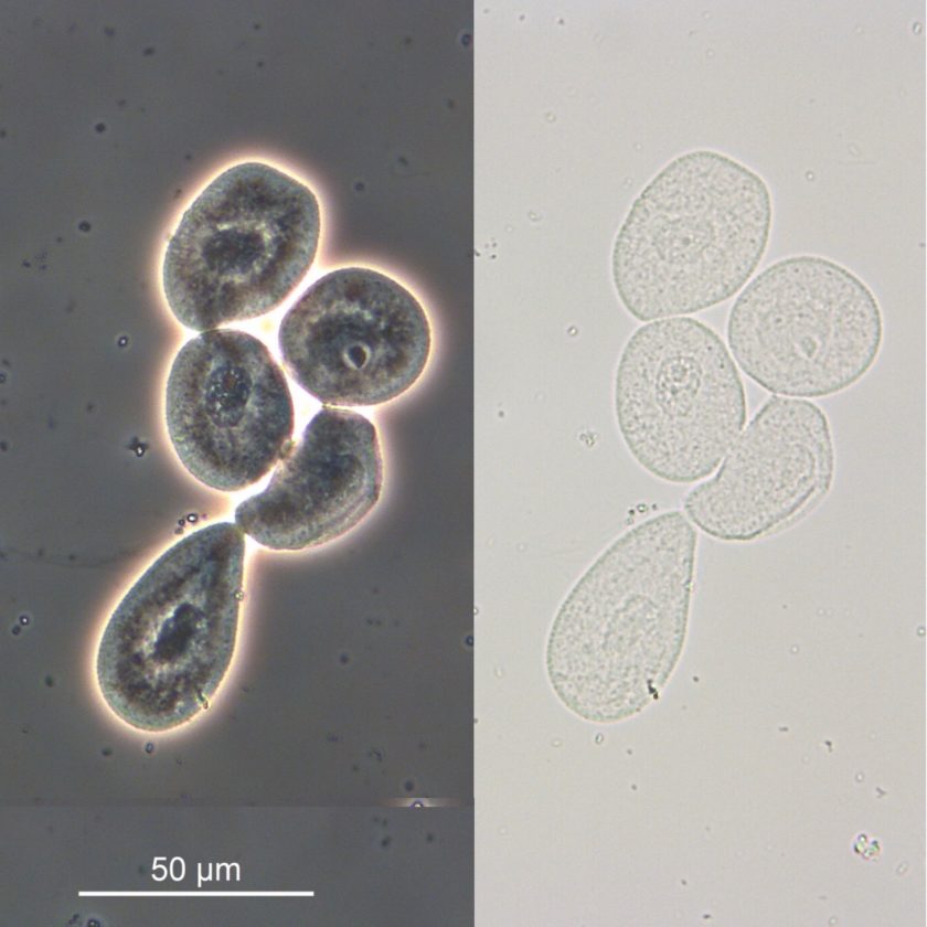 Urine Sediment of the Month: 4 Flavors of Nucleated Cells - Renal ...