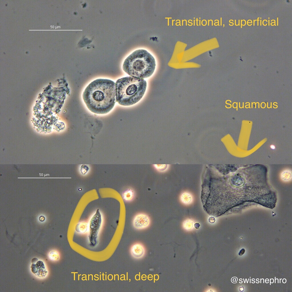 Urine Sediment of the Month: 4 Flavors of Nucleated Cells - Renal ...