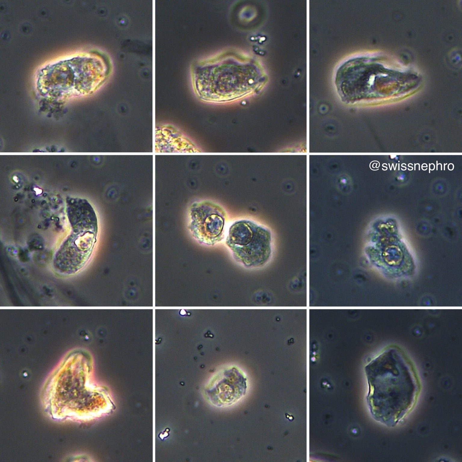 Urine Sediment of the Month: 4 Flavors of Nucleated Cells - Renal ...