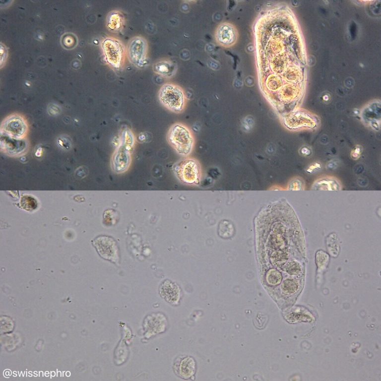 Urine Sediment of the Month: 4 Flavors of Nucleated Cells - Renal ...