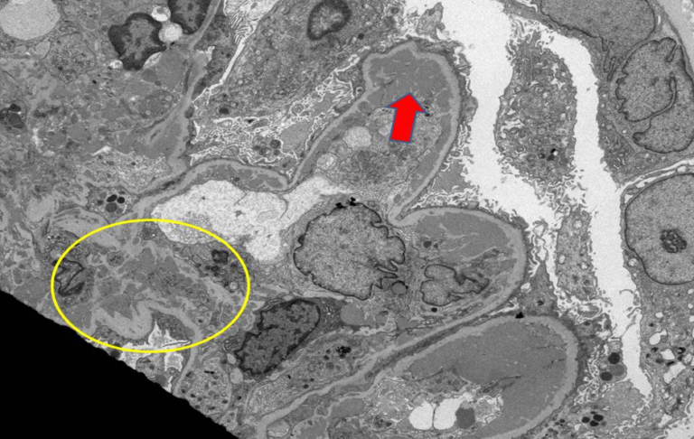 Kidney Biopsy of the Month: Lupus Nephritis - Renal Fellow Network