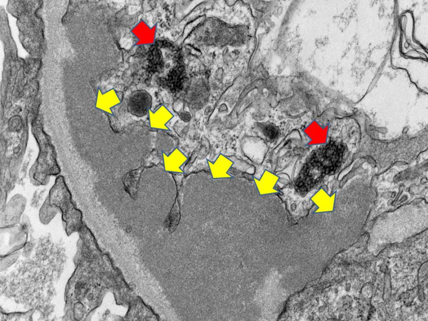 Kidney Biopsy of the Month: Lupus Nephritis - Renal Fellow Network