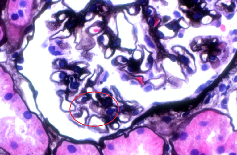 Kidney Biopsy of the Month: Lupus Nephritis - Renal Fellow Network