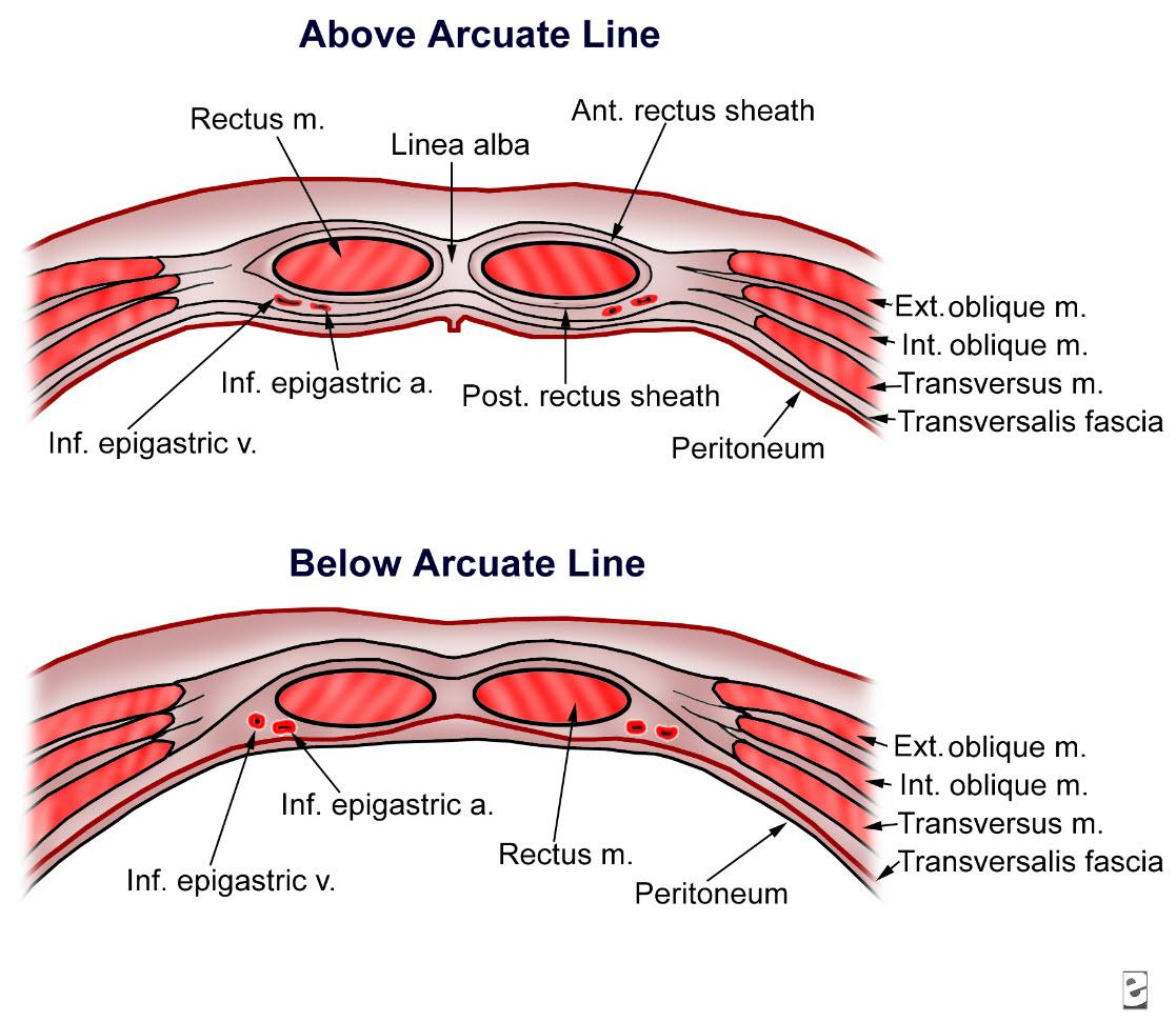 Tenckhoff Catheter Insertion by a Nephrologist - Renal Fellow Network