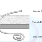 Tenckhoff Catheter Insertion by a Nephrologist - Renal Fellow Network