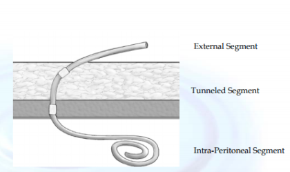 Tenckhoff Catheter Insertion by a Nephrologist - Renal Fellow Network