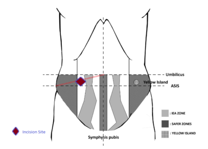 Tenckhoff Catheter Insertion by a Nephrologist - Renal Fellow Network