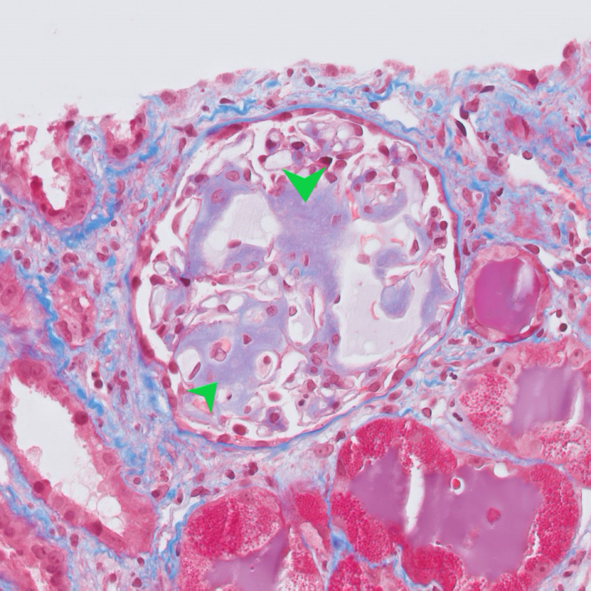 Kidney Biopsy of the Month: Amyloidosis - Renal Fellow Network