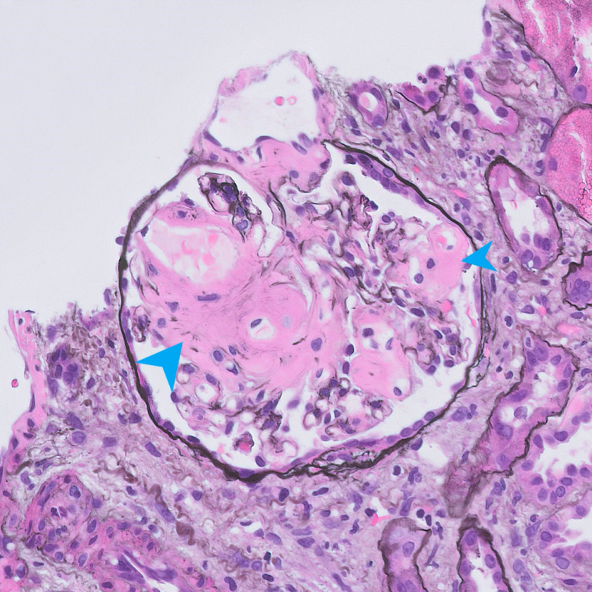 Kidney Biopsy of the Month: Amyloidosis - Renal Fellow Network