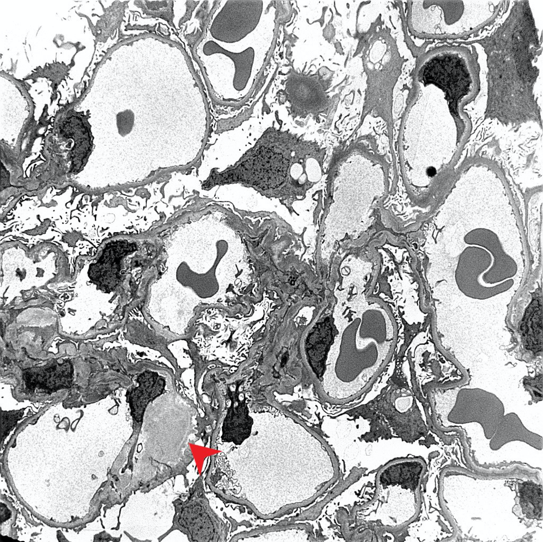 Kidney Biopsy of the Month: Amyloidosis - Renal Fellow Network