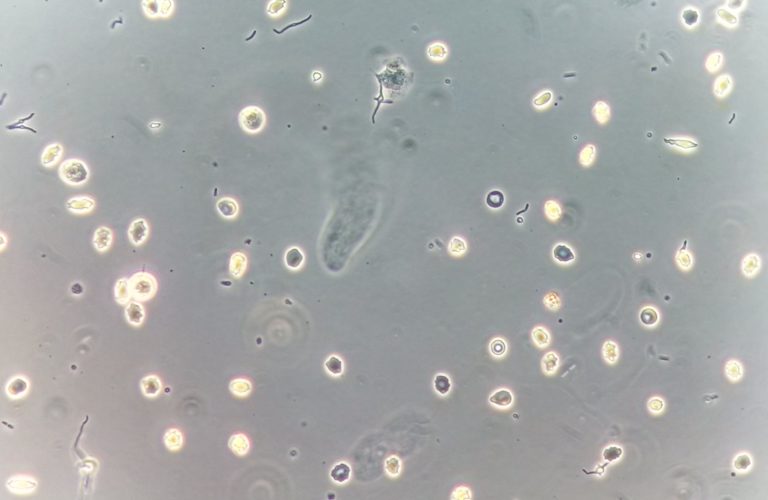 Urine Sediment of the Month: Bacterial Variant Forms - Renal Fellow Network