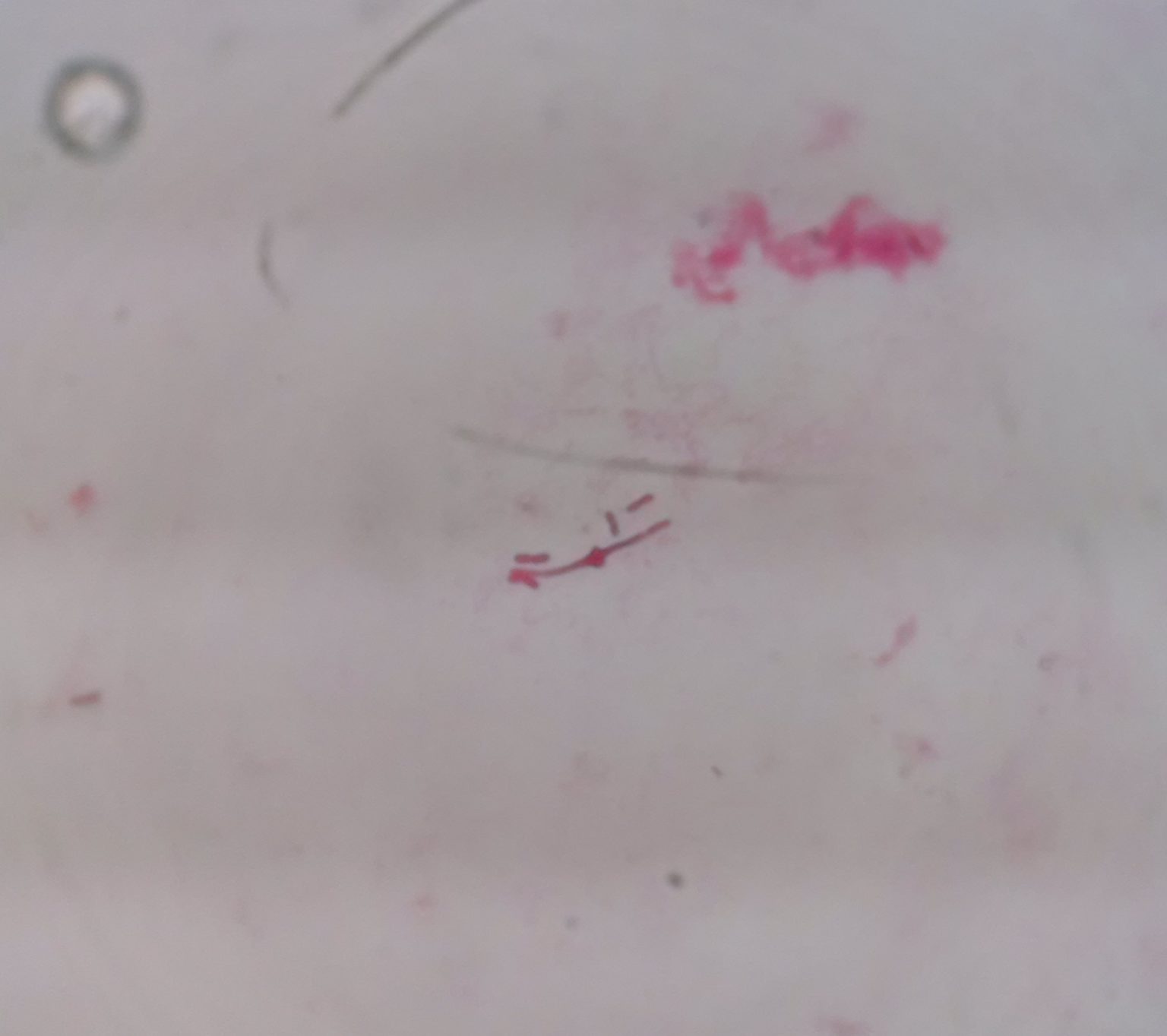 Urine Sediment of the Month: Bacterial Variant Forms - Renal Fellow Network