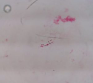 Urine Sediment of the Month: Bacterial Variant Forms - Renal Fellow Network