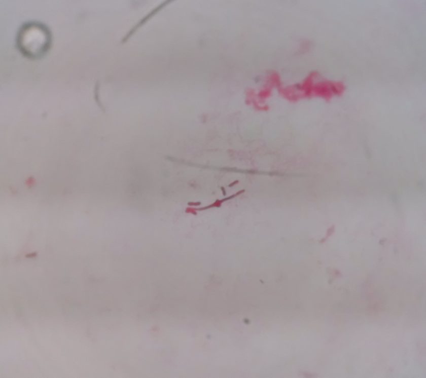 Urine Sediment of the Month: Bacterial Variant Forms - Renal Fellow Network