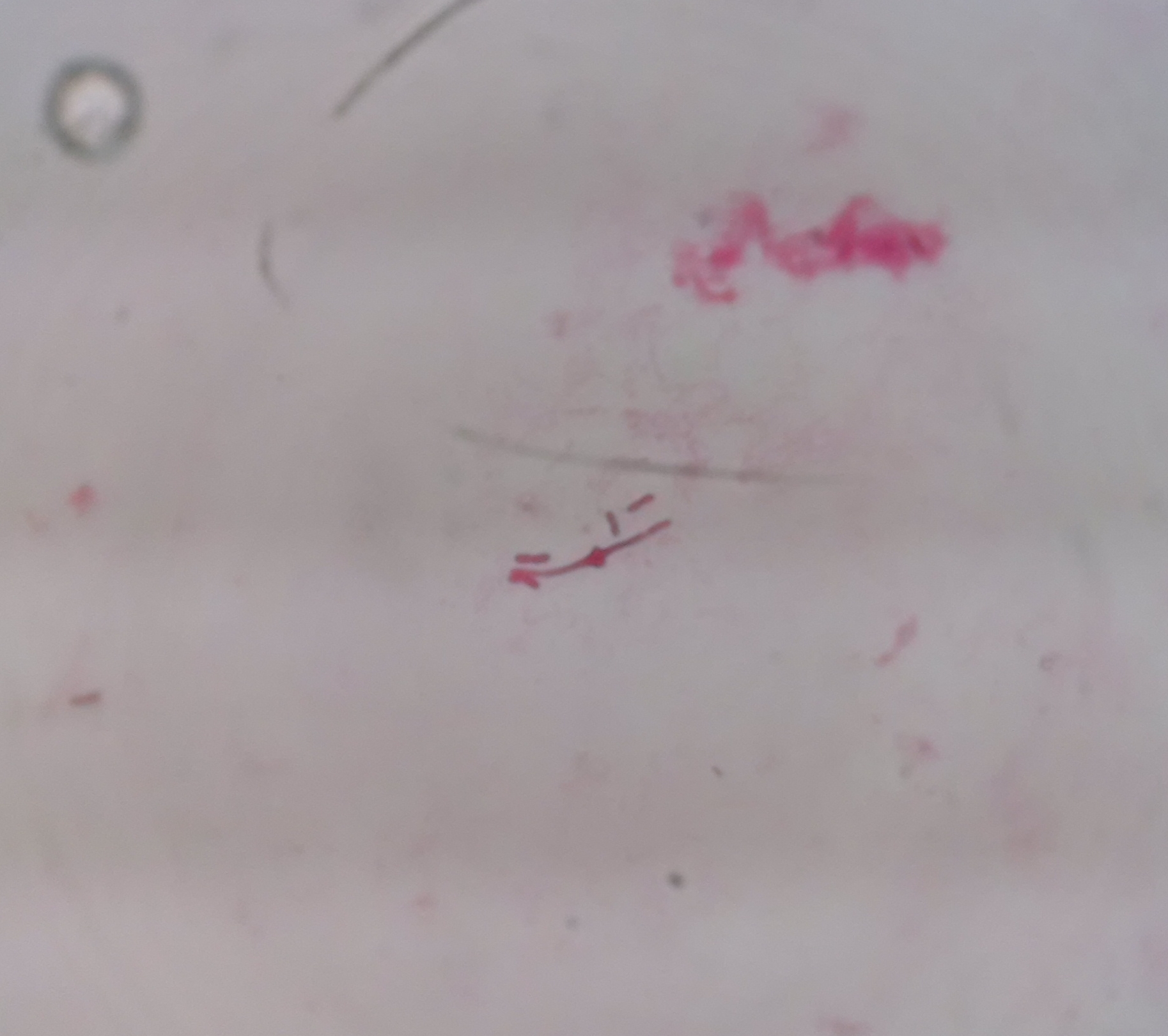 Urine Sediment of the Month: Bacterial Variant Forms - Renal Fellow Network