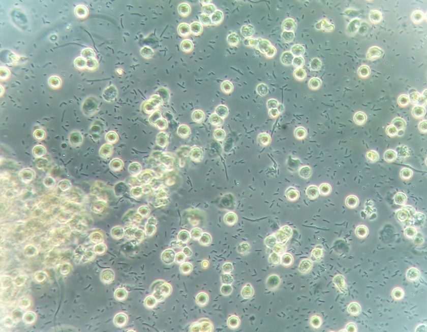 Urine Sediment of the Month: Bacterial Variant Forms - Renal Fellow Network