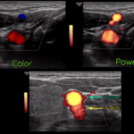 Basics of Doppler Ultrasound for the Nephrologist: Part 1 - Renal ...