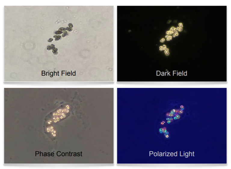 Urine Sediment of the Month: Transmitted Light Microscopy Techniques ...