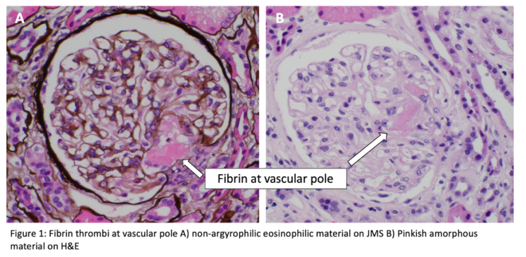 Kidney Biopsy of the Month: Thrombotic Microangiopathy - Renal Fellow ...