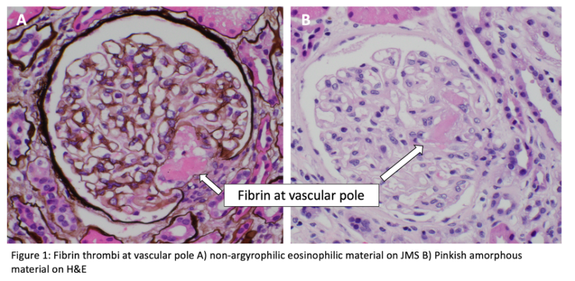 Kidney Biopsy of the Month: Thrombotic Microangiopathy - Renal Fellow ...