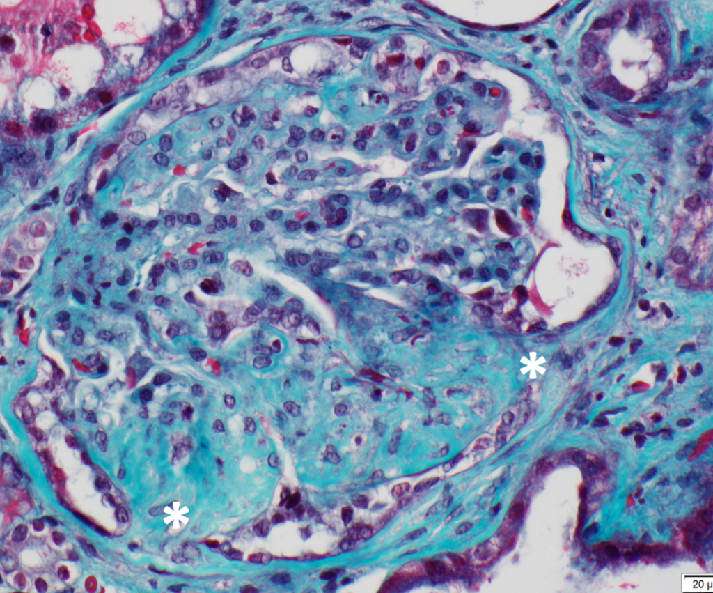 Kidney Biopsy of the Month: Thrombotic Microangiopathy - Renal Fellow ...