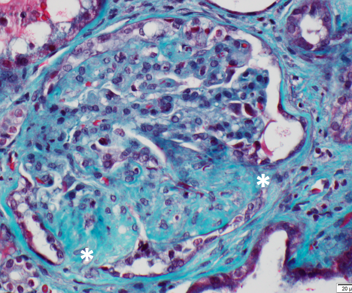 Kidney Biopsy of the Month: Thrombotic Microangiopathy - Renal Fellow ...