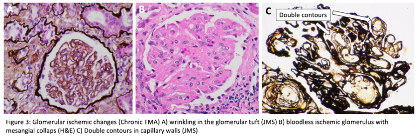 Kidney Biopsy of the Month: Thrombotic Microangiopathy - Renal Fellow ...