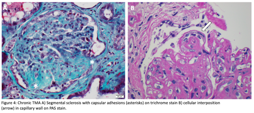 Kidney Biopsy of the Month: Thrombotic Microangiopathy - Renal Fellow ...