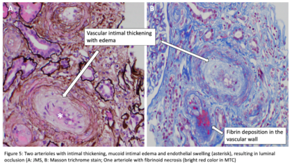 Kidney Biopsy of the Month: Thrombotic Microangiopathy - Renal Fellow ...