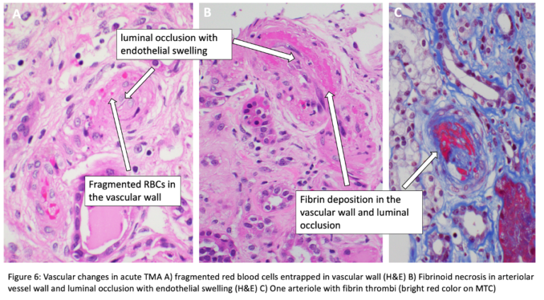 Kidney Biopsy of the Month: Thrombotic Microangiopathy - Renal Fellow ...