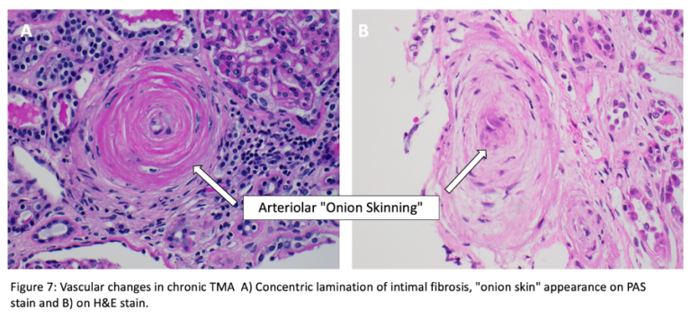 Kidney Biopsy of the Month: Thrombotic Microangiopathy - Renal Fellow ...