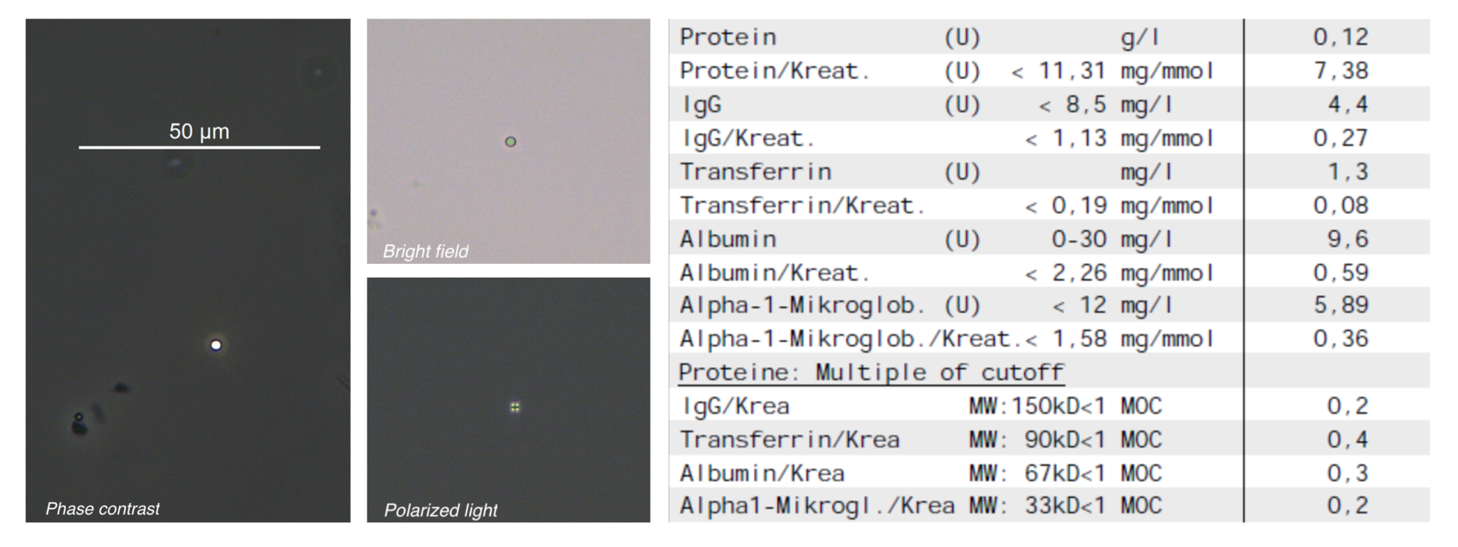 Urine Sediment of the Month: Isolated Lipiduria - Renal Fellow Network