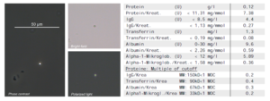 Urine Sediment of the Month: Isolated Lipiduria - Renal Fellow Network