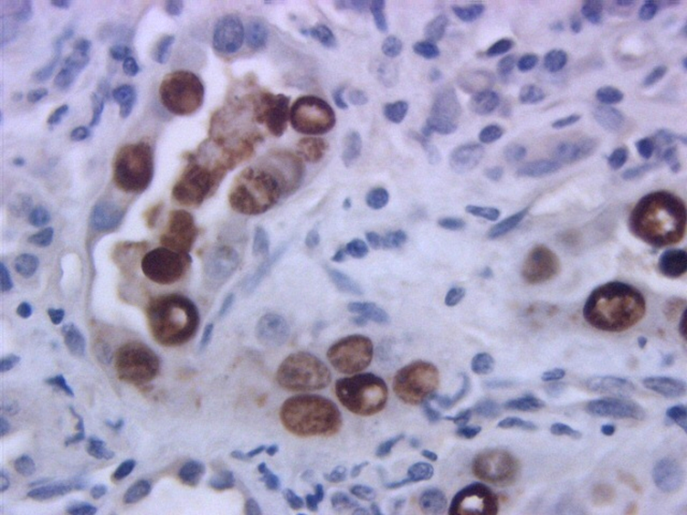 Kidney Biopsy of the Month: BK virus nephropathy - Renal Fellow Network