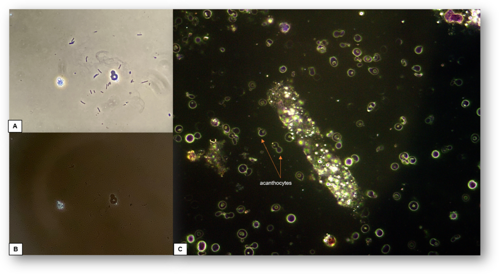 Urine Sediment of the Month: Evidence of Nephritic & Nephrotic Syndrome ...