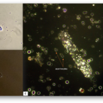 Urine Sediment of the Month: Evidence of Nephritic & Nephrotic Syndrome ...
