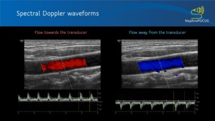 Basics of Doppler Ultrasound for the Nephrologist- Part 2 - Renal ...