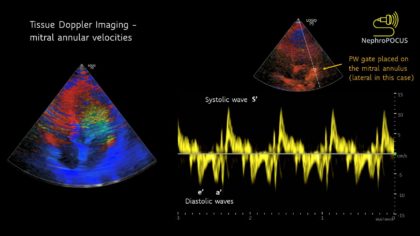 Basics of Doppler Ultrasound for the Nephrologist- Part 2 - Renal ...